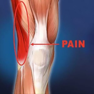 Anatomy of Iliotibial Band (IT Band) – Dr Abhinav Mishra