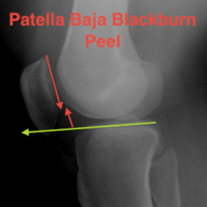 Patella Baja – Dr Abhinav Mishra
