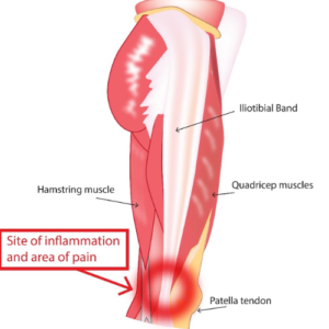 Patellar Clunk Syndrome – Dr Abhinav Mishra