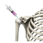 Subacromial Space – Dr Abhinav Mishra