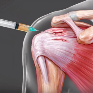Subacromial Space – Dr Abhinav Mishra